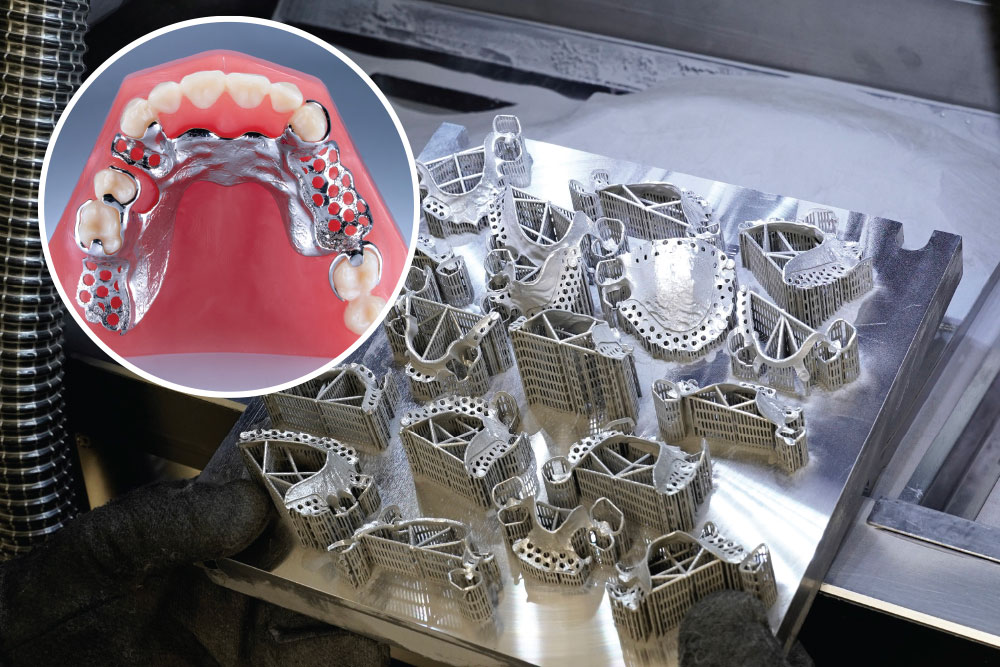 RPD Framework | Dental Framework Lab | Bestodental