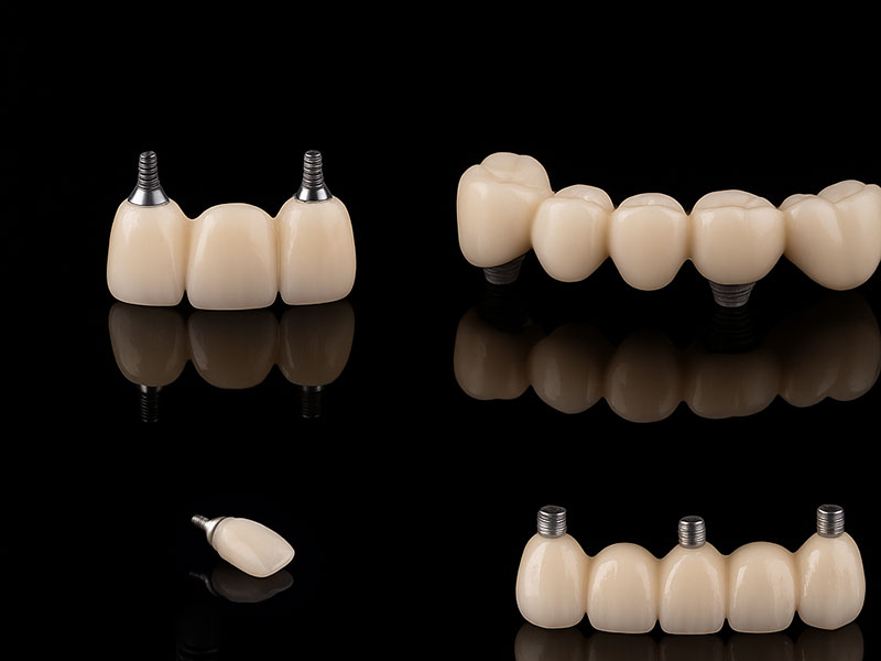 Dental Implant Restorations | Dental Implant Lab | Bestodental