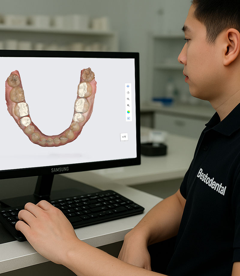 Inlay Onlay Restorations | Inlay and Onlay Lab | Bestodental