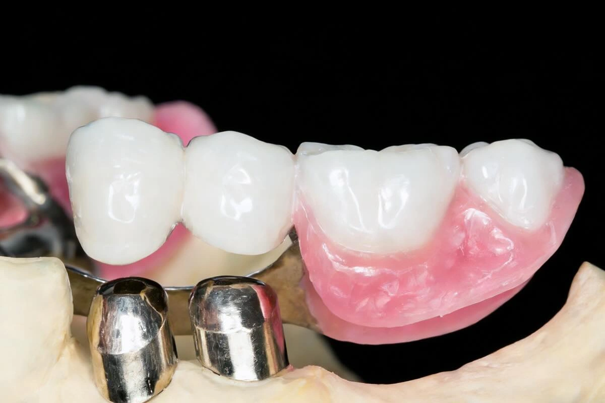 Telescopic Restoration Outsourcing Guide: How to Outsource Crown ...